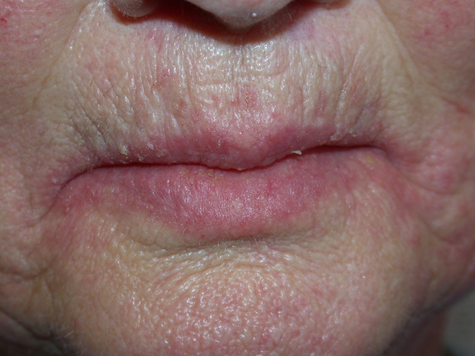 Mykosen, Mund und Rachen - Deximed