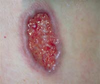 Pyoderma gangraenosum - Deximed