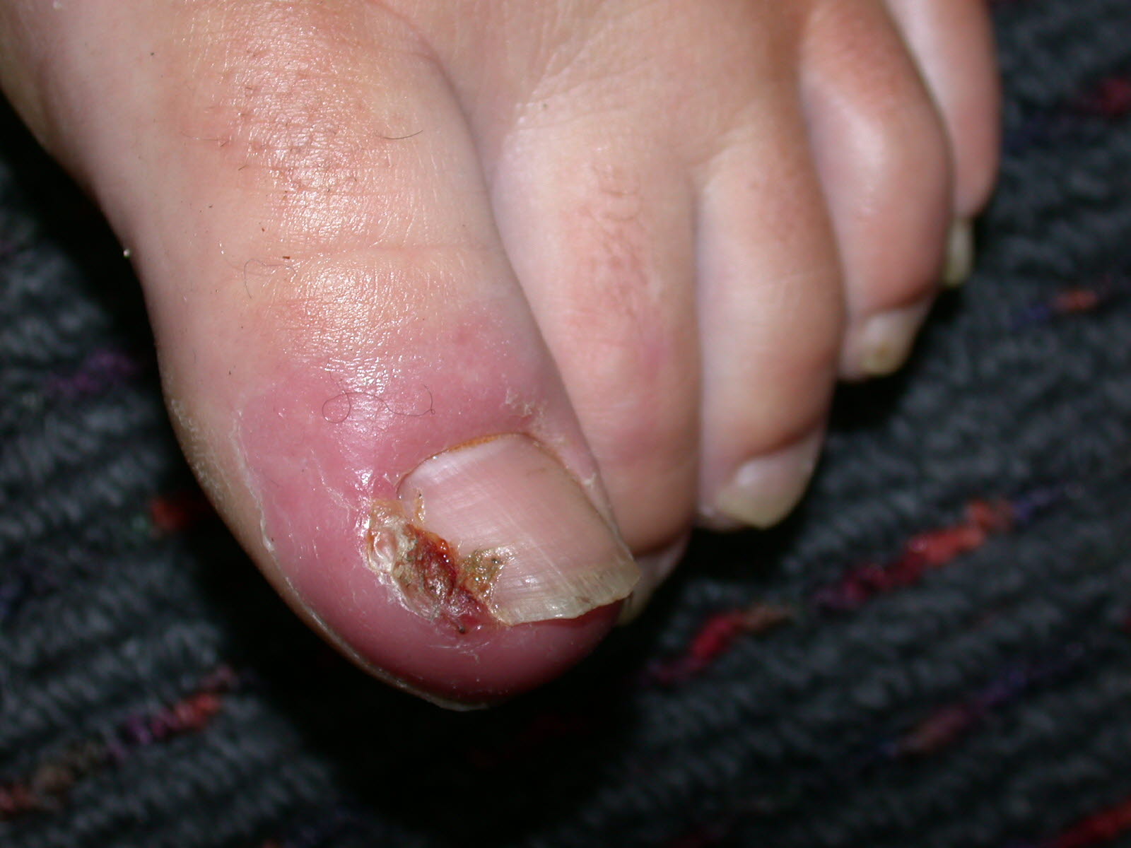 Eingewachsener Zehennagel - Deximed