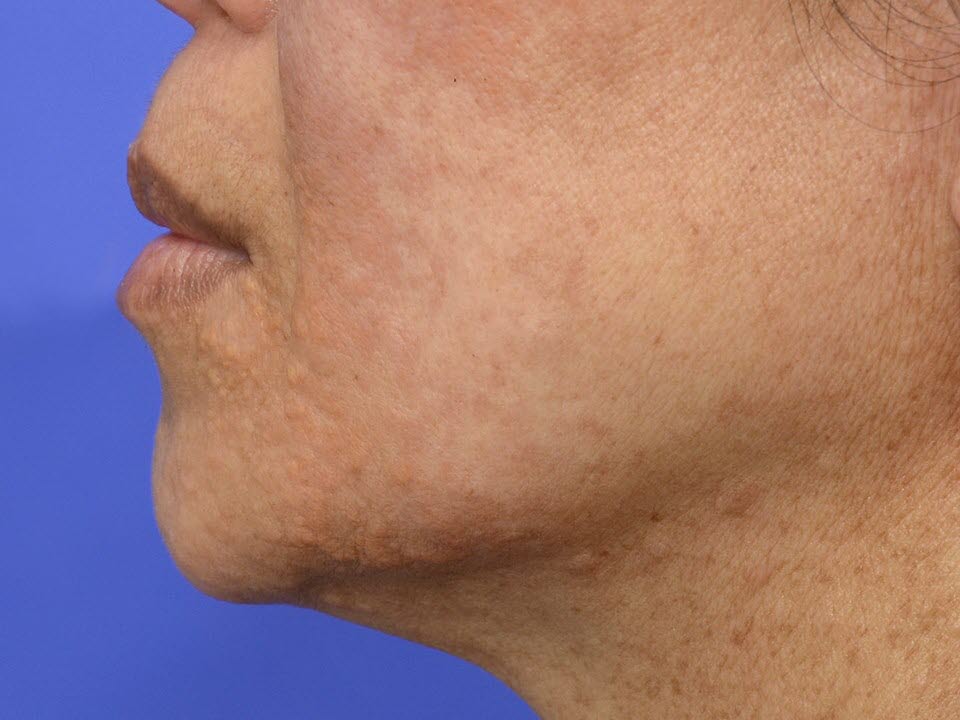 Hyperlipidämie - Deximed