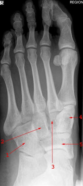 Navikularefraktur - Deximed