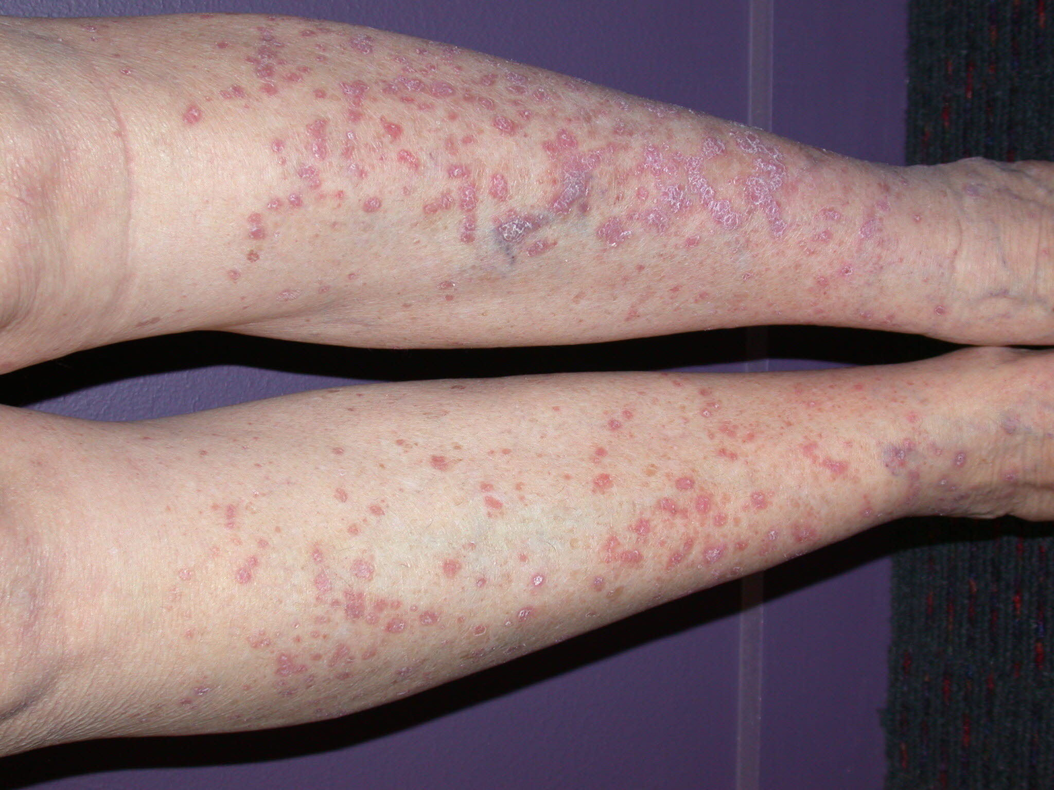 Lichen ruber planus - Deximed