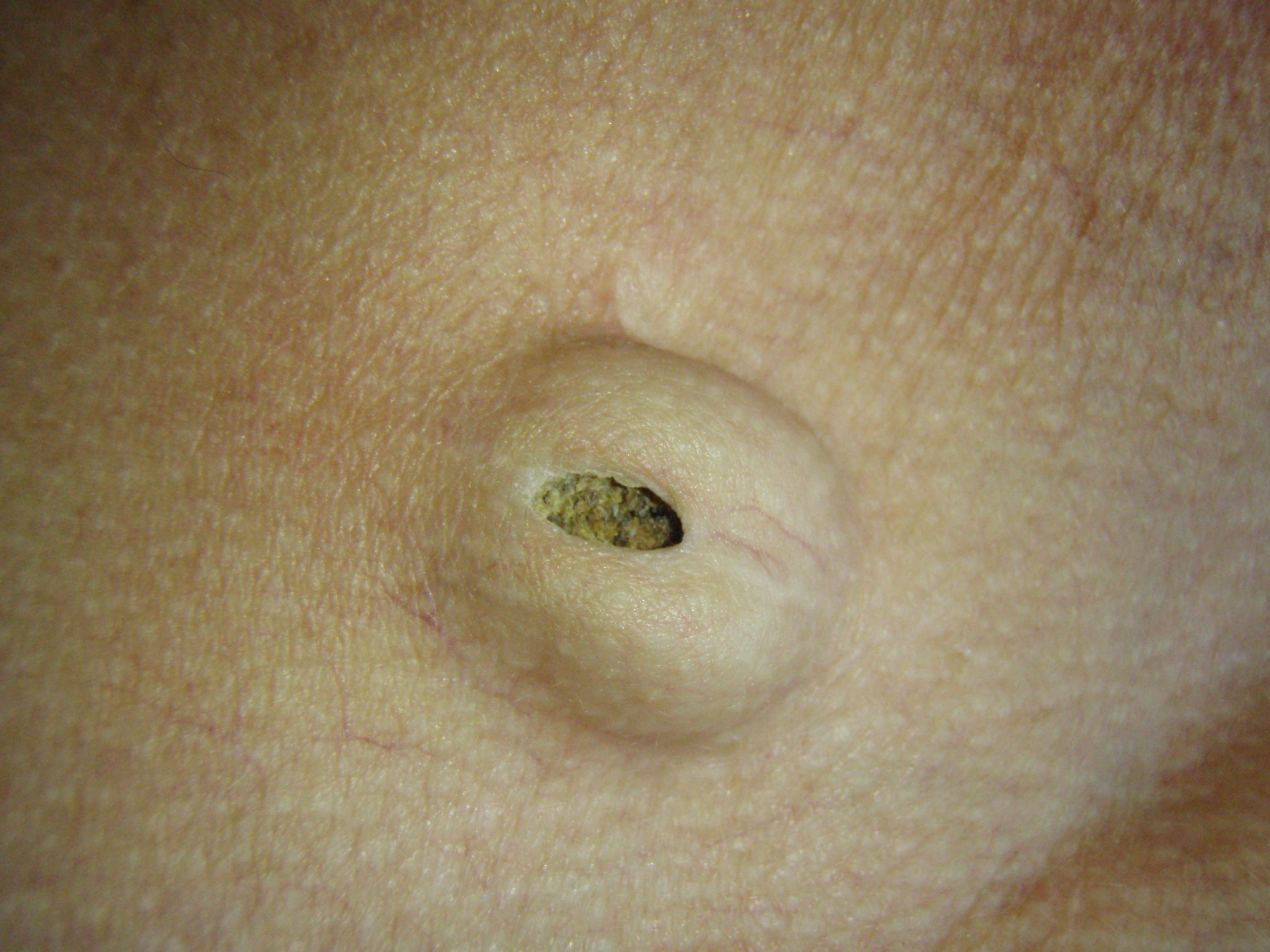 Epidermoidzyste - Deximed