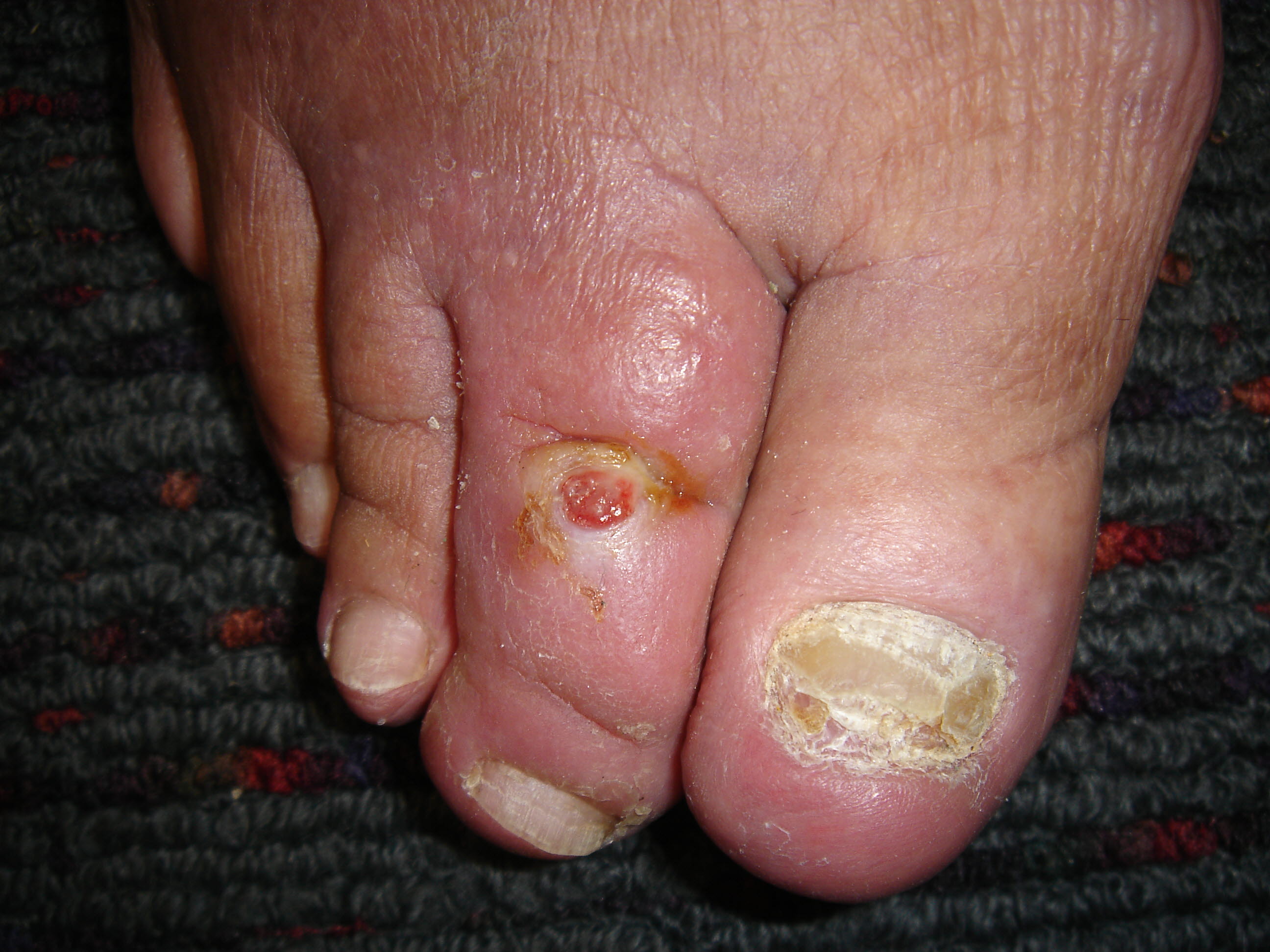 Ulcus cruris arteriosum - Deximed