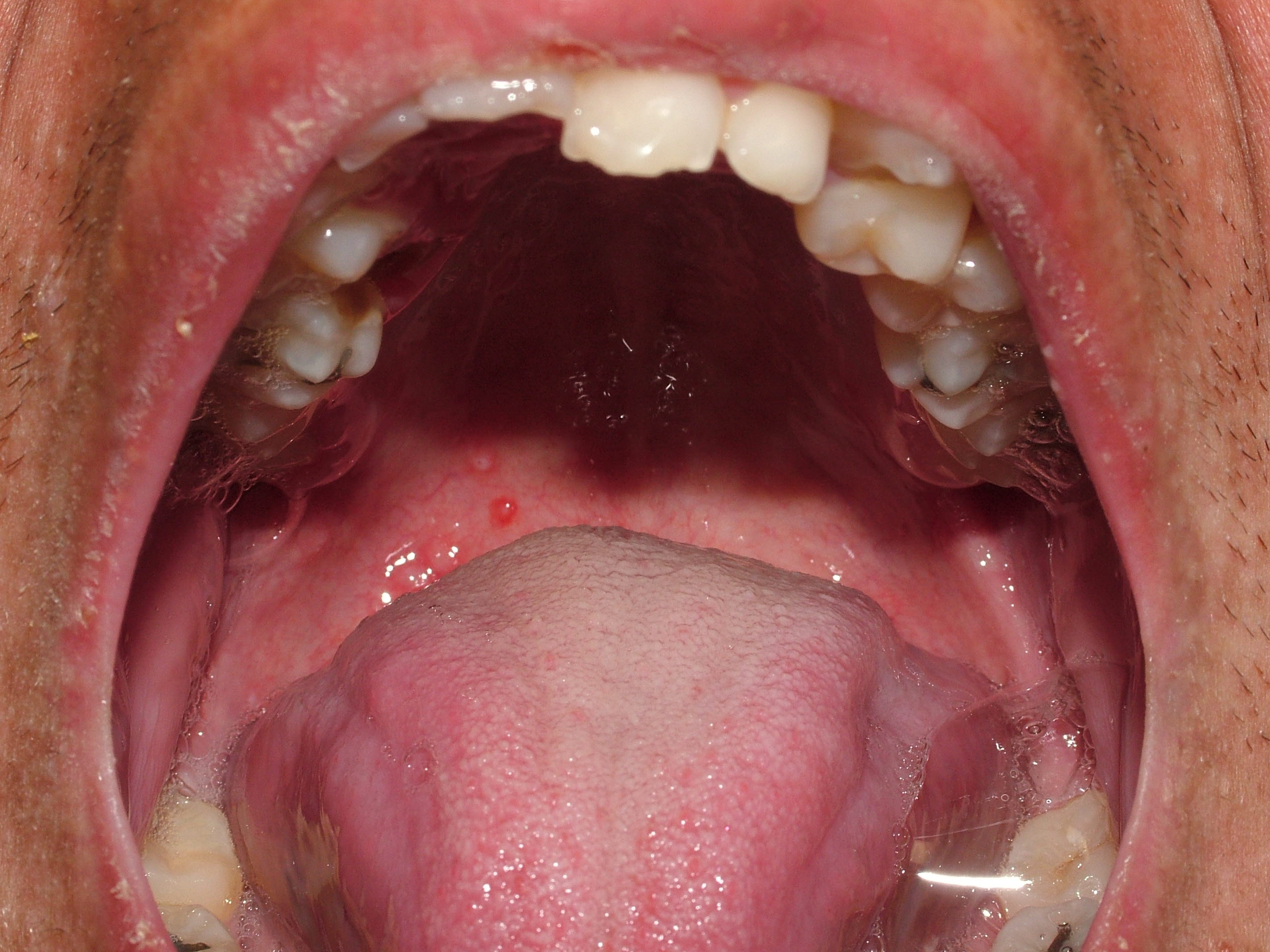 Windpocken - Deximed