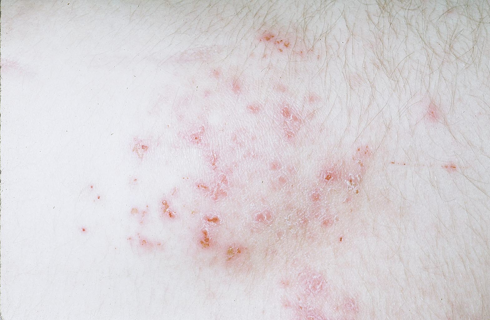 Dermatitis herpetiformis Duhring (DHD) - Deximed