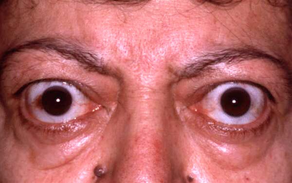 Endokrine Orbitopathie - Deximed