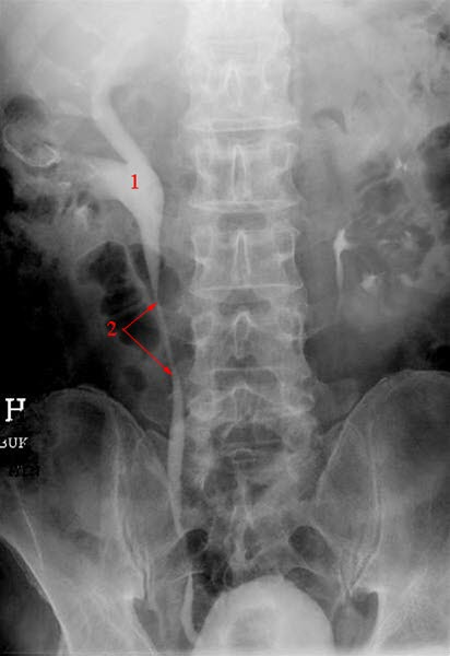 Hydronephrose - Deximed