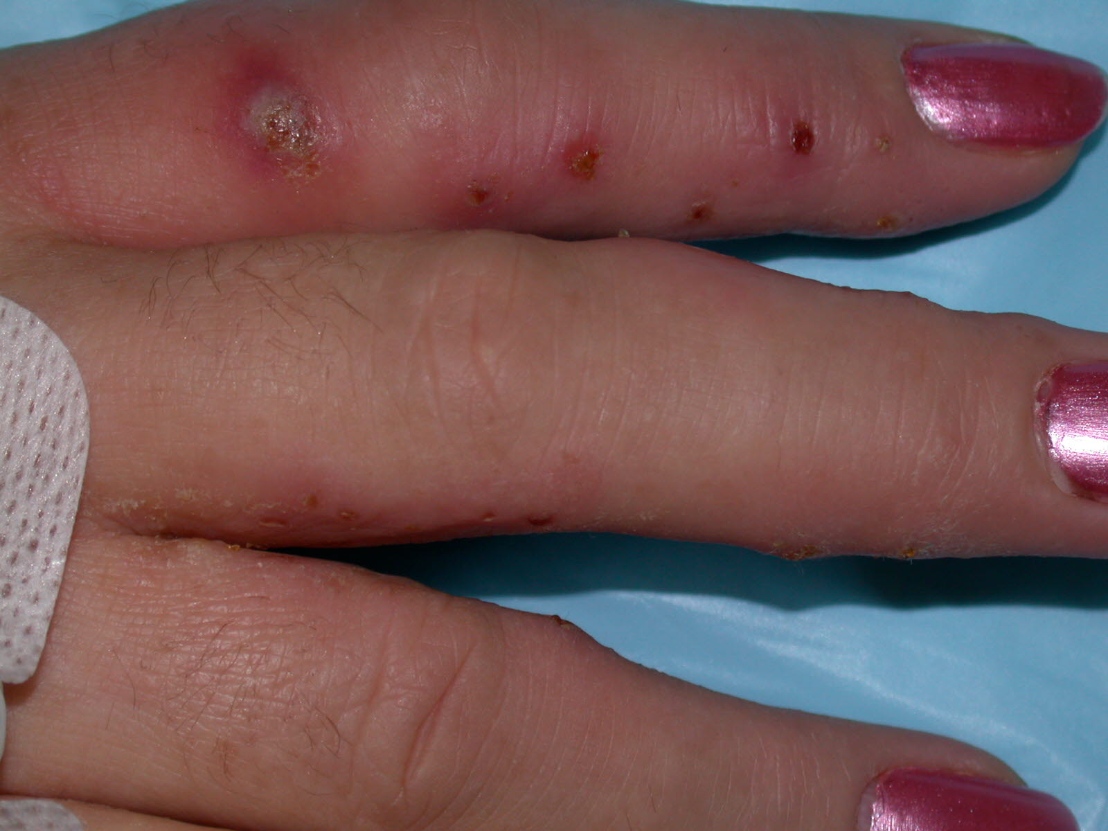 Dyshidrosis - Deximed