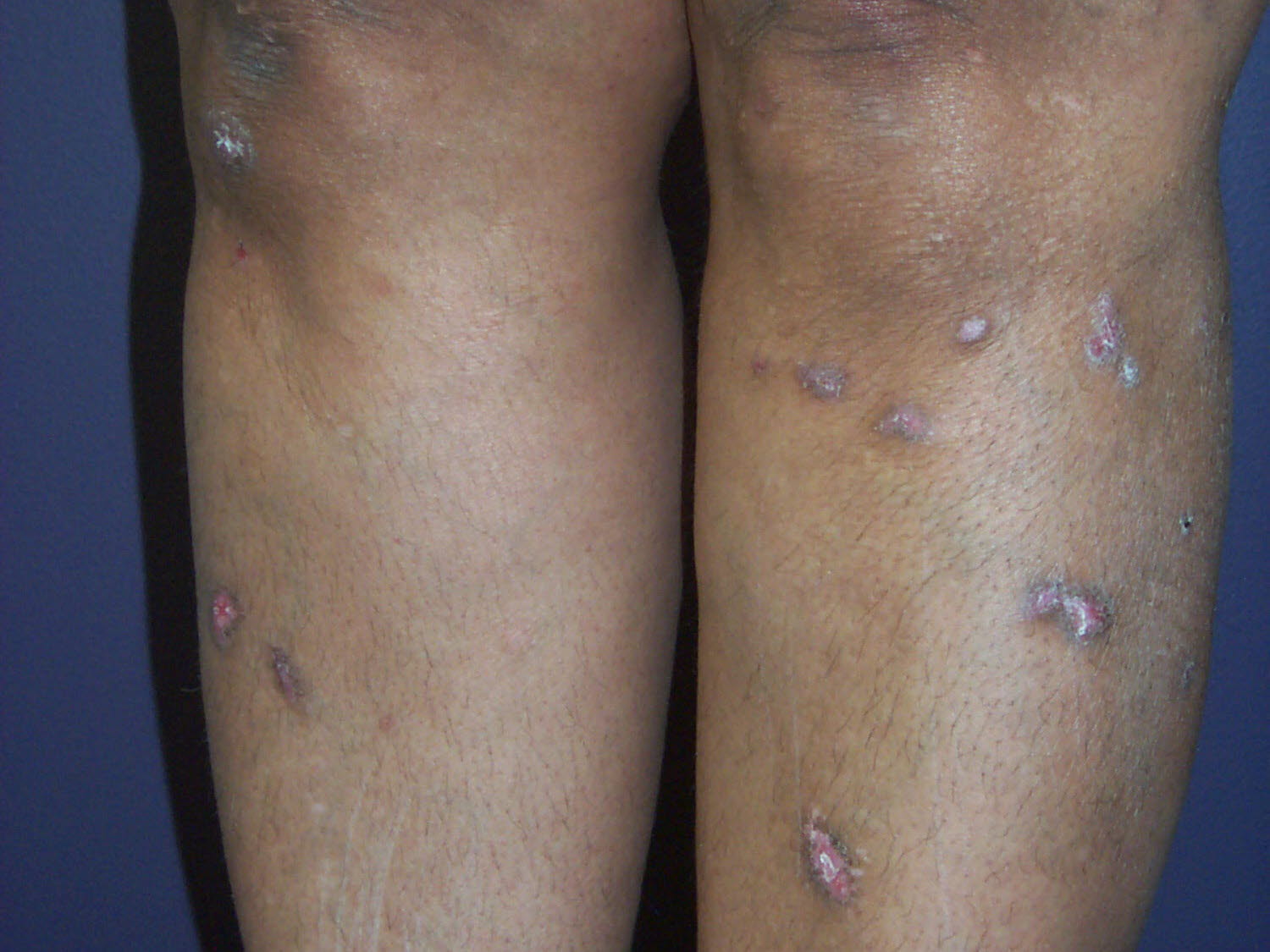 Lichen ruber planus (Knötchenflechte) - Deximed