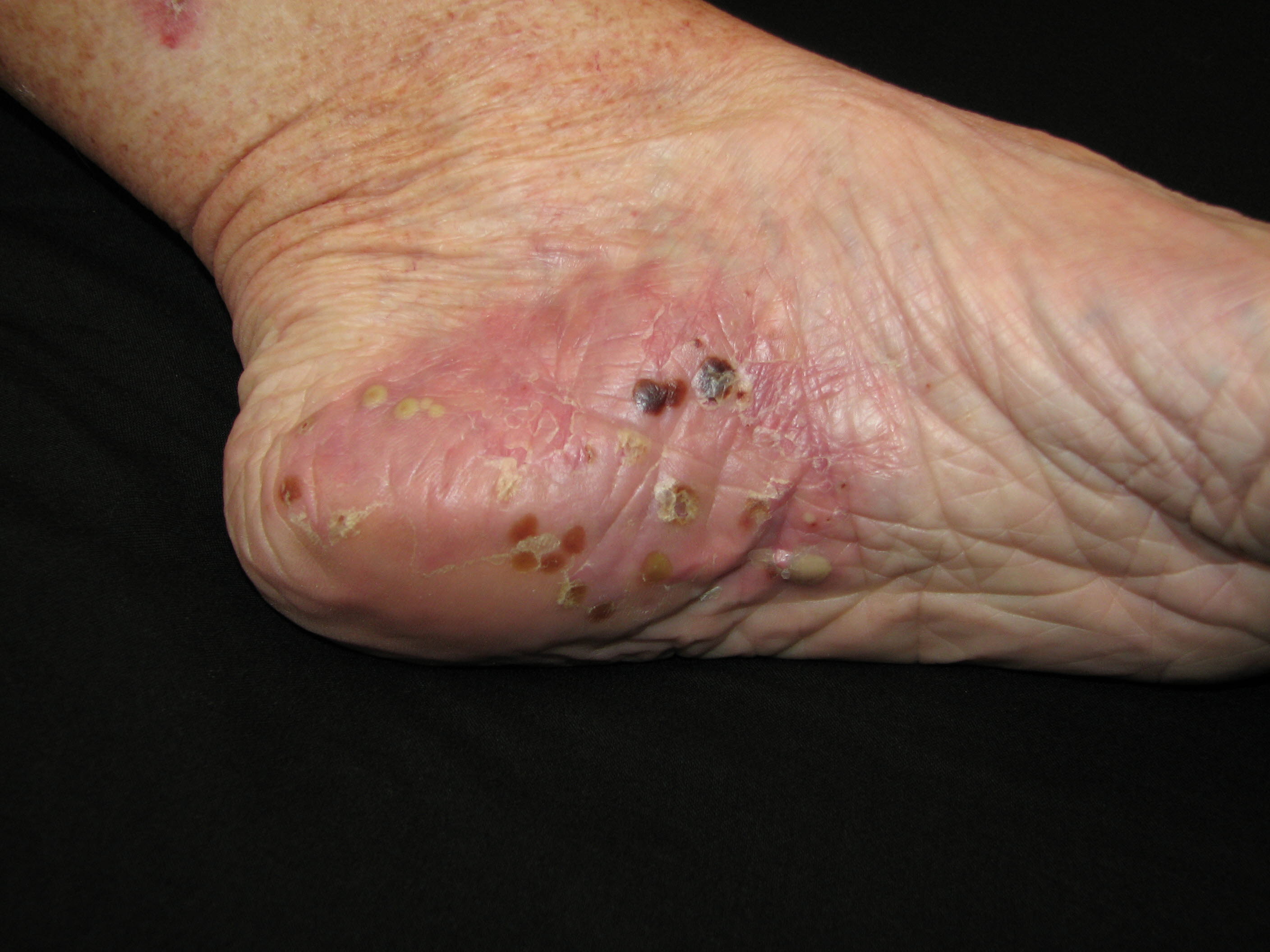 Pustulosis palmoplantaris - Deximed