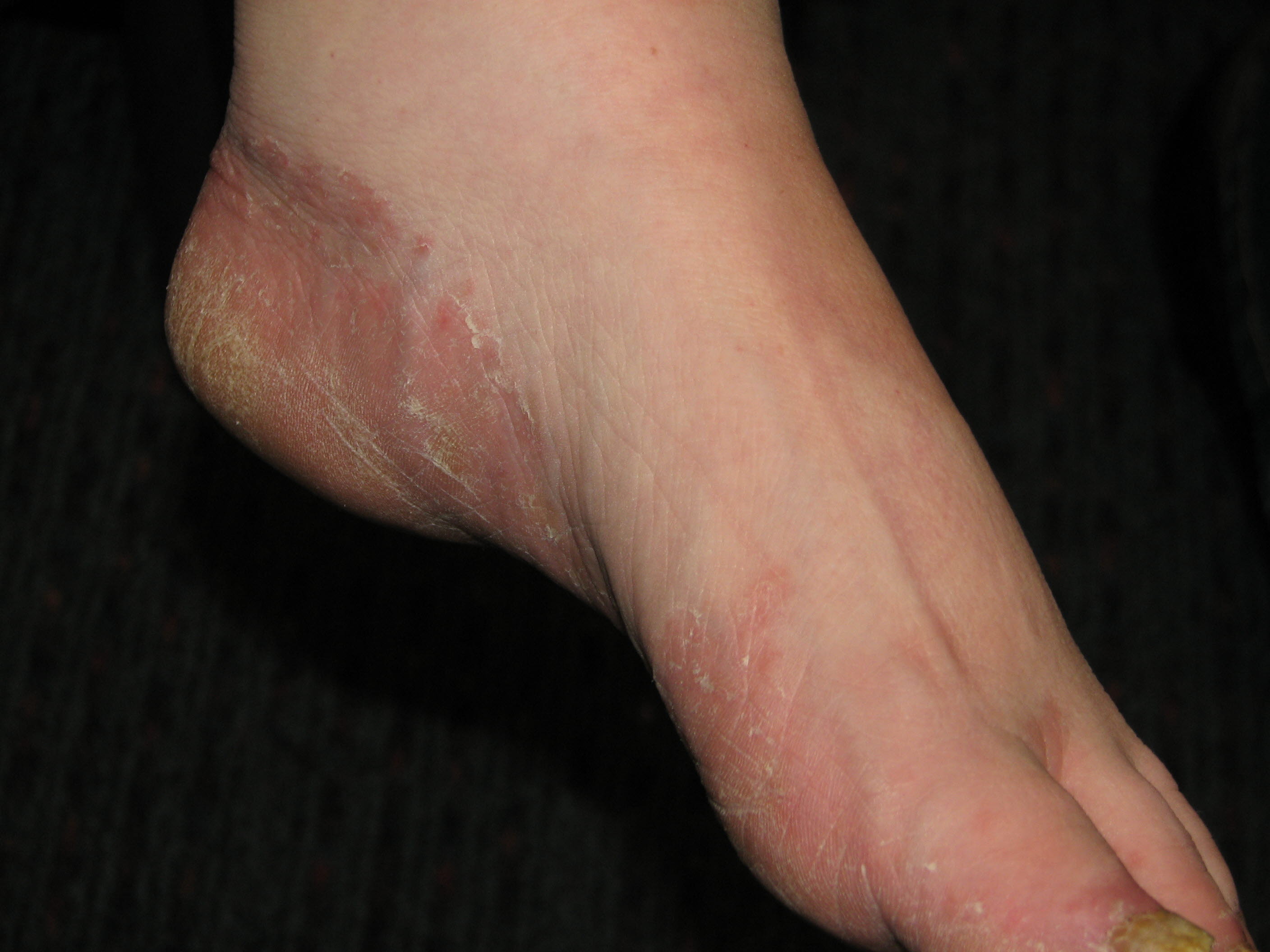 Fußpilz (Tinea pedis) - Deximed