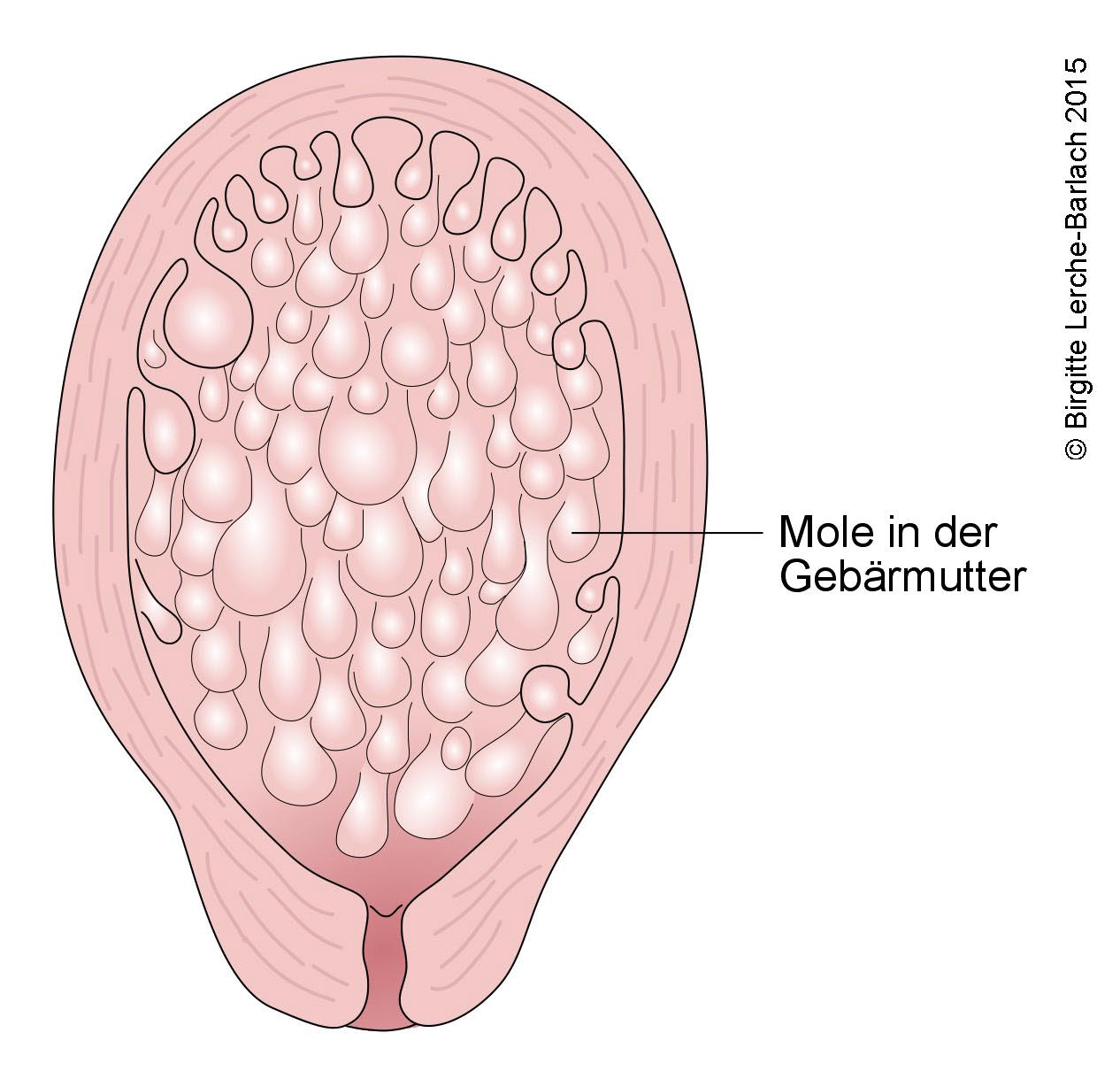 Trophoblasterkrankungen - Deximed