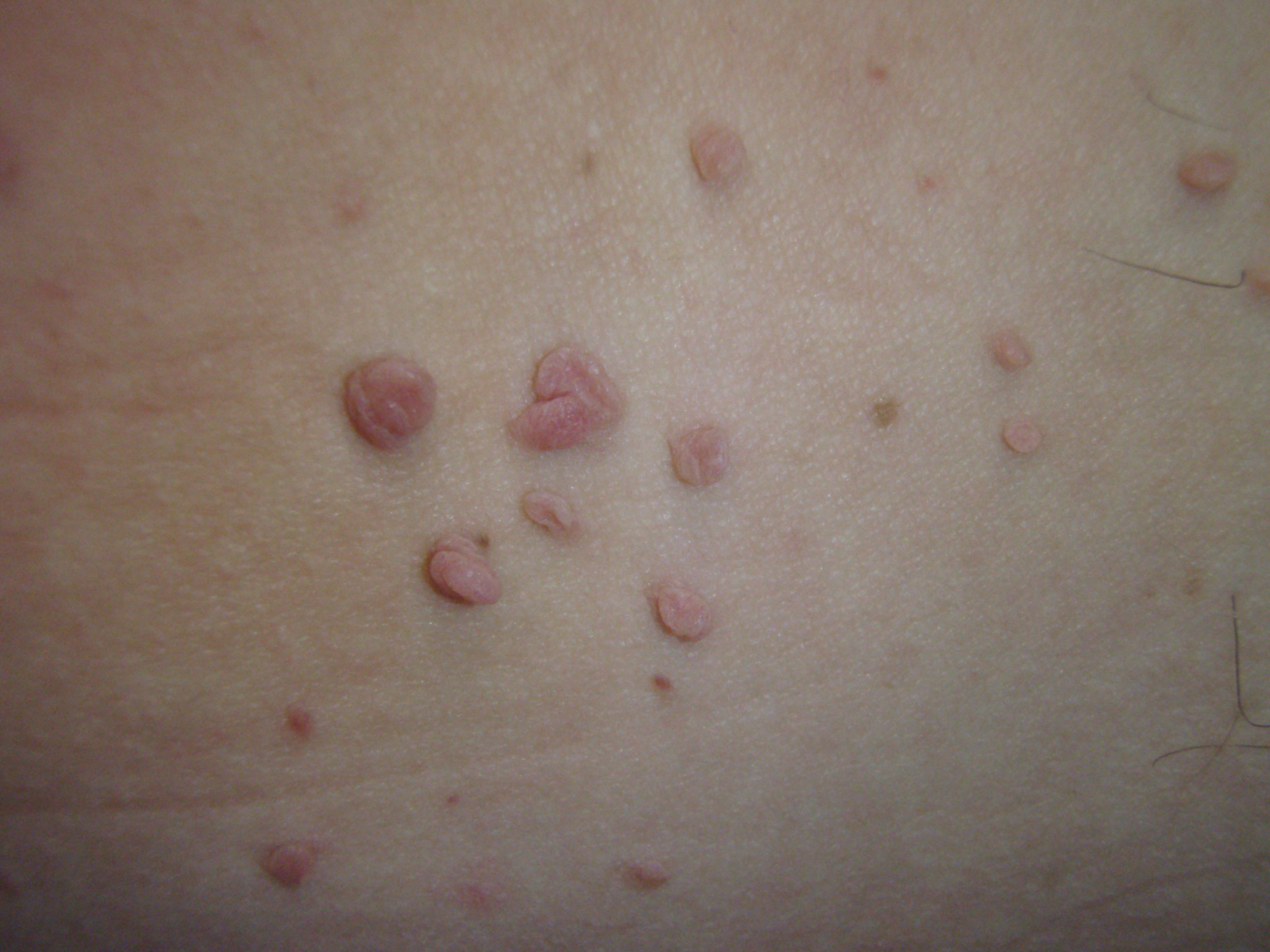 Fibroma molle - Deximed