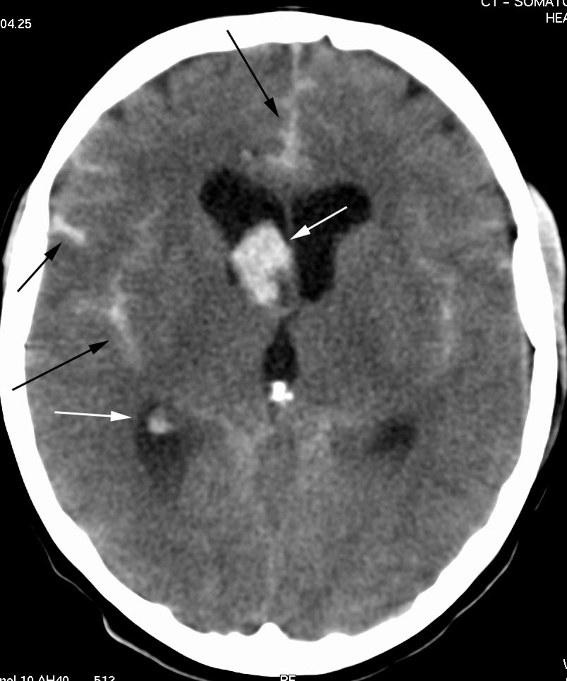 Schlaganfall und TIA - Deximed