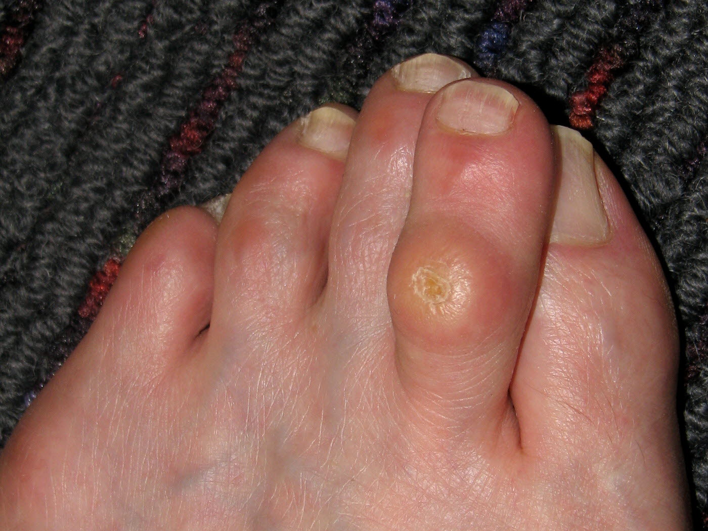 Clavus (Hühnerauge) - Deximed