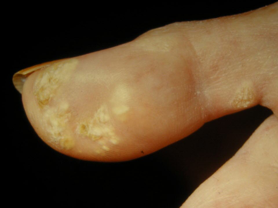 Hyperparathyreoidismus - Deximed