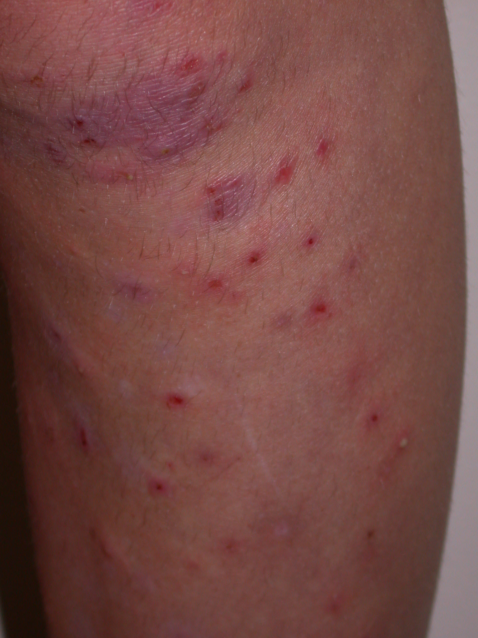 Follikulitis/Furunkulose - Deximed